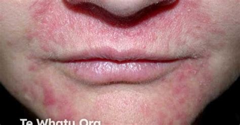 Perioral Dermatitis Image