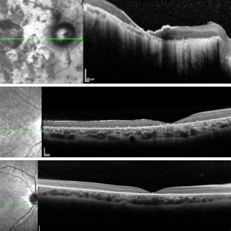 Fundus Photography And Oct Performed In Two Patients With Confirmed
