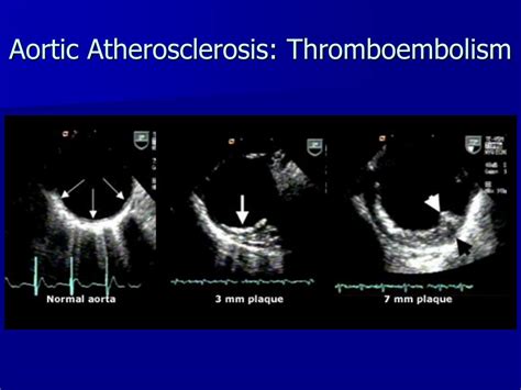 Ppt Echocardiography In The Evaluation Of Intracardiac Sources Of
