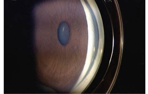 Secondary Glaucoma Flashcards Quizlet