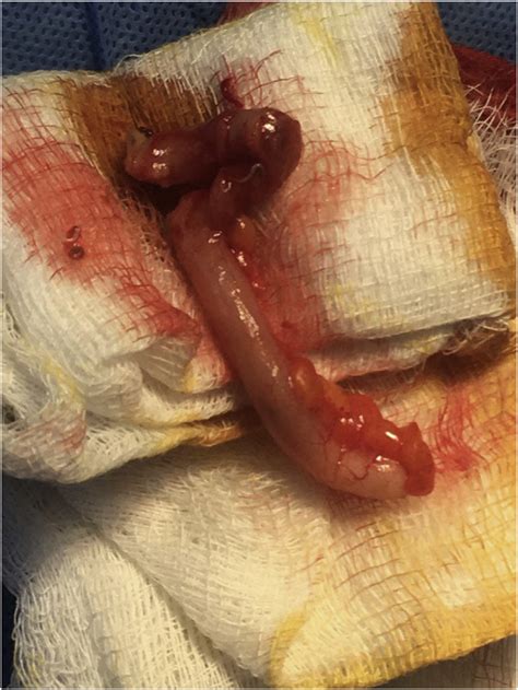Appendix After Resection With The Word Seen Inside The Lumen