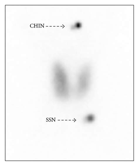 Twenty Four Hour Radioactive Iodine 123 Uptake Test The Images Show