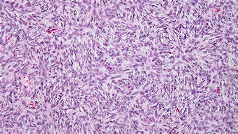Rare Cutaneous Sarcoma More Common In Black Individuals