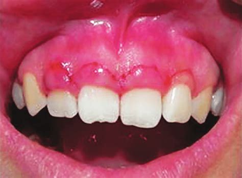 Line Of Excision Marked By Joining The Bleeding Points Made Using