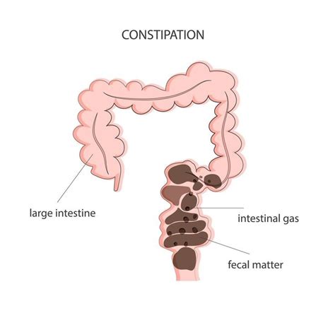 Constipation Nursing Diagnosis And Care Plans