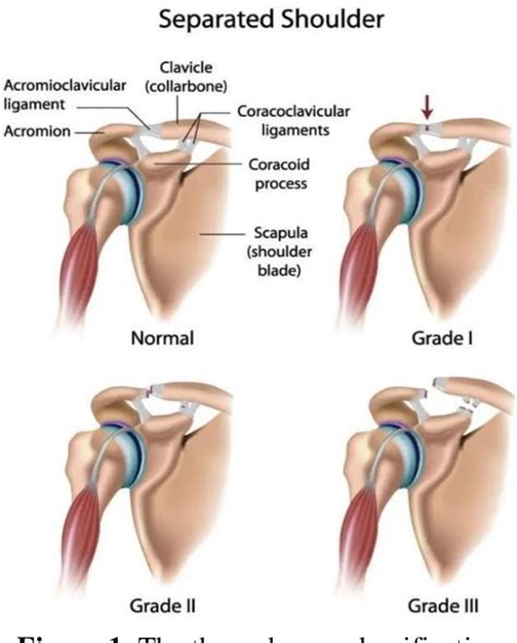 Figure 1 From Characteristics And Comparison Of Tossy And Rockwood Classifications For