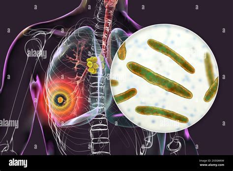Illustration Of Primary Lung Tuberculosis Featuring The Ghon Complex And Mediastinal
