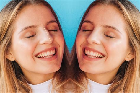 Invisalign Before And After Your Journey To A Perfect Smile