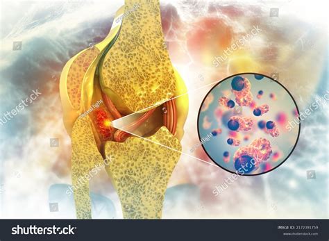 Bone Cancer Bones