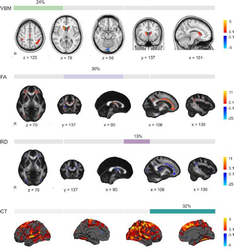 Spatial Maps Of Each Modality In Component 2 The Percentage Of