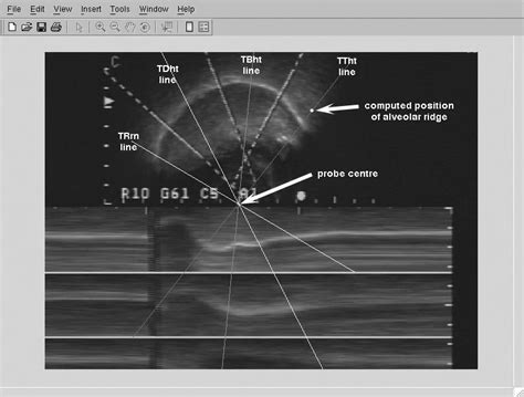 8 Ultrasound Frame In Matlab Showing Four Measurement Lines Download Scientific Diagram