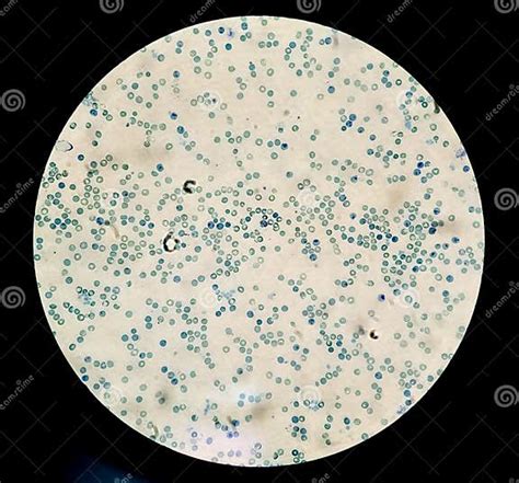 Microscopic Image Of Abnormal High Reticulocytes Count Nucleated Rbc