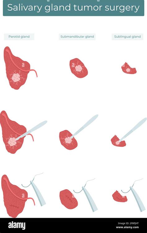 Vector Flat Illustration Of Surgical Removal Of A Tumor From The