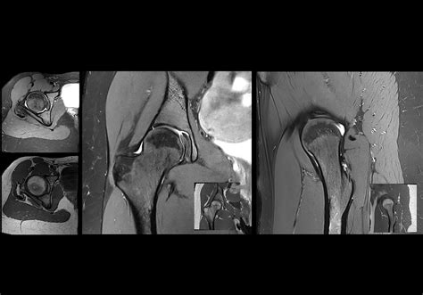 Anatomy Of The Hip Labeled Mri E Anatomy