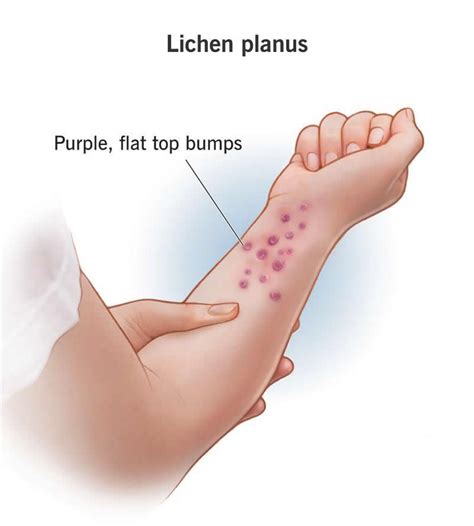 Lichen Planus What It Is Causes Types And Treatments Wockr