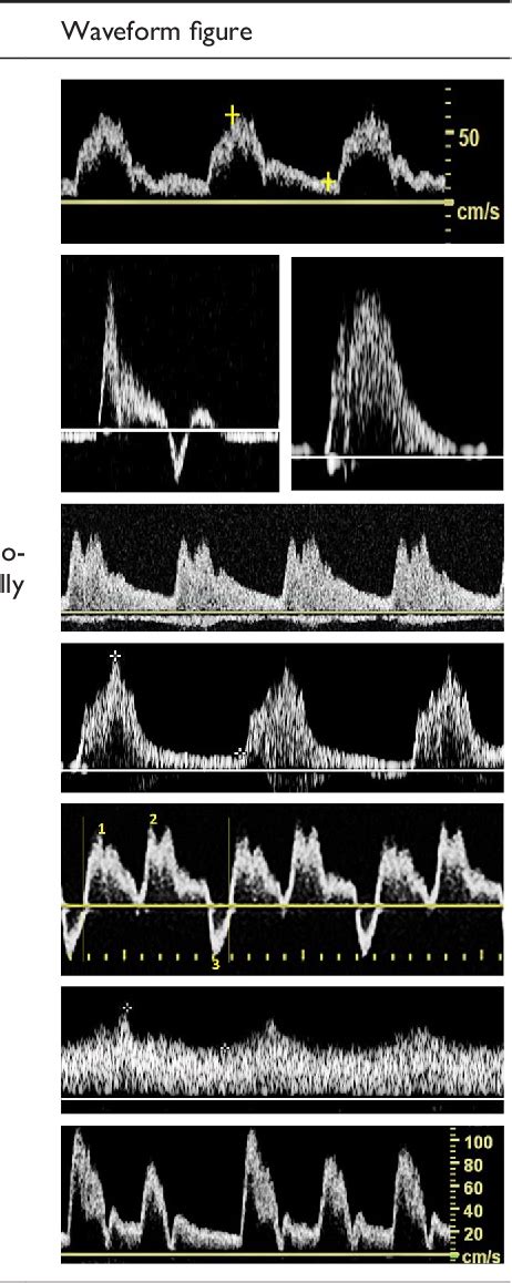 Pdf Interpretation Of Peripheral Arterial And Venous Doppler