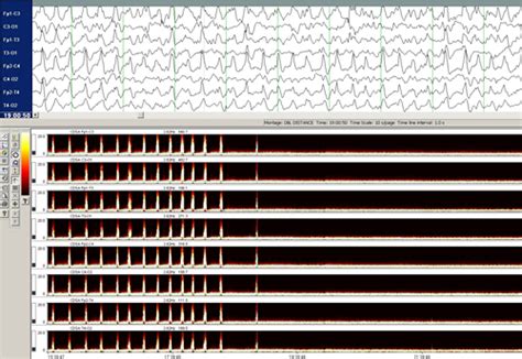 Utility Of Color Density Spectral Array And Amplitude Integrated