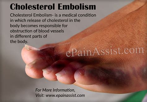 Cholesterol Emboli