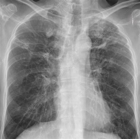 Tuberculosis X Ray Stock Image F043 6810 Science Photo Library