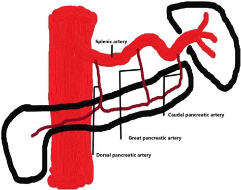 Splenic Artery Embolization For Trauma A Narrative Review Pmc