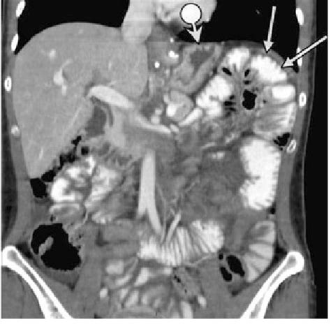 Pdf Petersens Hernia As A Complication Of Bariatric Surgery Ct Findings