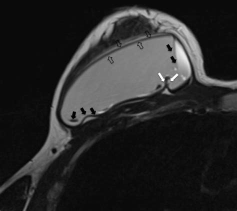 Breast Implant Intra And Extracapsular Rupture Associated With Axillary