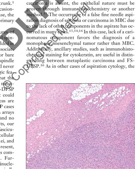 Histologic Findings Of Fs Dfsp A Superficial Poorly Demarcated Area