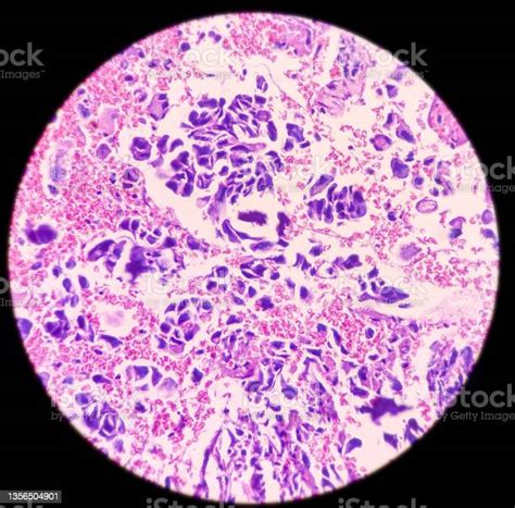 Kanker Tulang Foto Osteosarcoma Di Tulang Ini Kanker Yang Sangat Langka Foto Stok Unduh Gambar