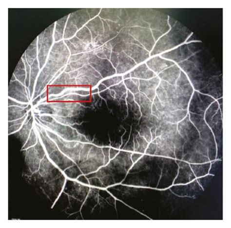 Features Of Retinal Microvascular Disease A Crve Increases Avr Download Scientific Diagram