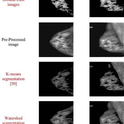 Original And Segmented Mammogram Images A Benign And B Malignant