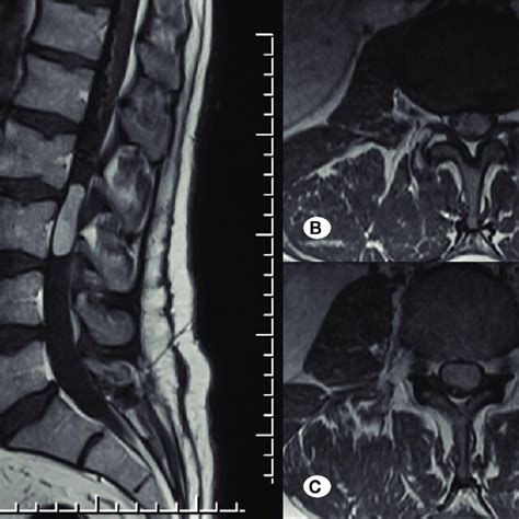 Contrastenhanced Lumbar Magnetic Resonance Imaging Shows A Regularly