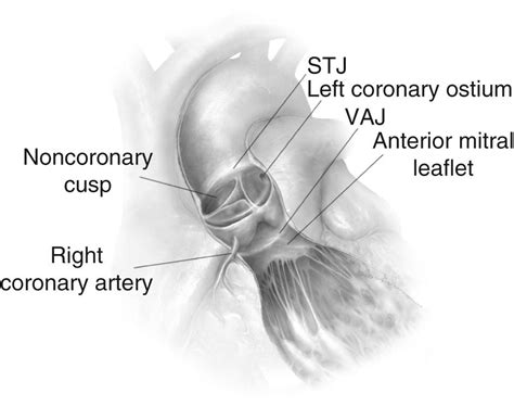 Aortic Valve Repair Clinical Tree