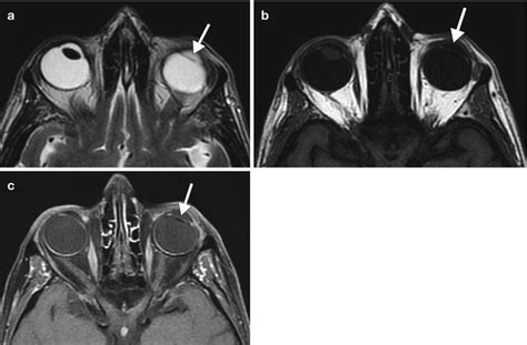 Imaging After Cataract And Intraocular Lens Implant Surgery Springerlink