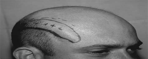 Temporalis Muscle Hypertrophy A New Plastic Surgery Procedu