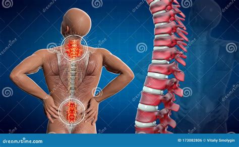 Protrusion Of The Intervertebral Disc Hernia Vector Illustration On