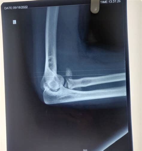 1st Case Of Radial Head Excision Arthroplasty And Replacemnt With… Dr Akash Metkar