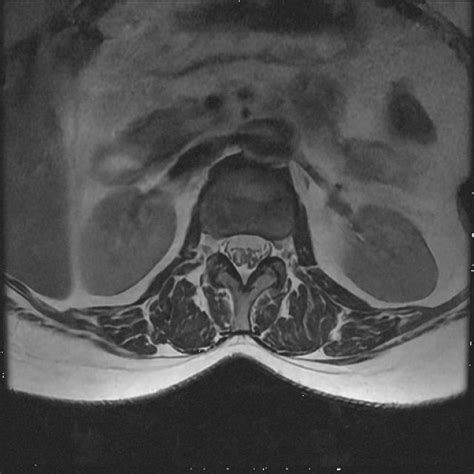 Spinal Disc Object Detection Dataset By Manasvis