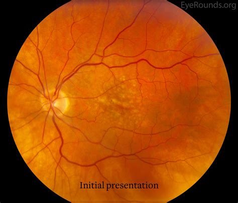 Age Related Macular Degeneration