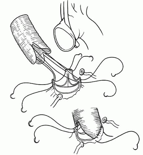 Annuloaortic Ectasia Thoracic Key