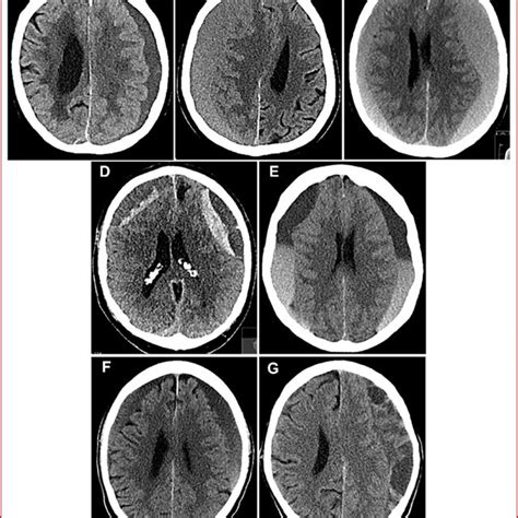 Pdf A Reliable Grading System For Prediction Of Chronic Subdural Hematoma Recurrence Requiring