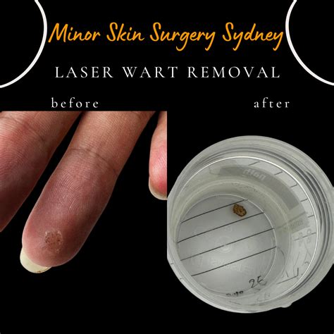 Laser Wart Removal And Treatment Sydney Finger Warts Plantar Warts