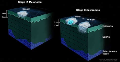 The 5 Stages Of Nail Melanoma Upsmash
