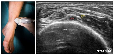 Ultrasound Guided Ankle Block Nysora Web App Nysora