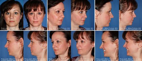 Flat Nose Before And After Photo Gallery Nose Surgery Photos