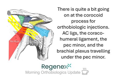 The Coracoid Process Is A Great Spot For Orthobiologic Injections From Chris Centeno Md The Coracoid Process Is A Great Spot For Orthobiologic Injections From Chris Centeno Md
