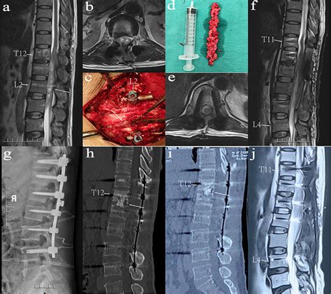 A Lumbar Drug Resistant Tuberculosis A Case Report And Review Of Lite