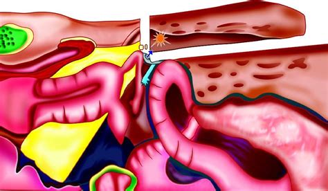 Safety During Use Of Electrosurgery In Laparoscopic Surgery