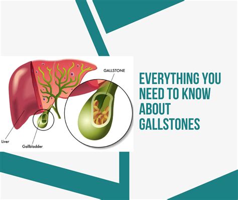 Everything You Need To Know About Gallstones