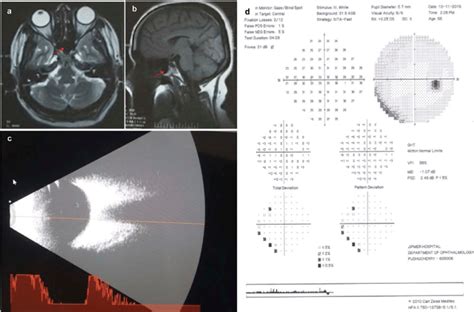 Ab Axial And Sagittal Mri Brain Showing Hypoplastic Optic Nerves