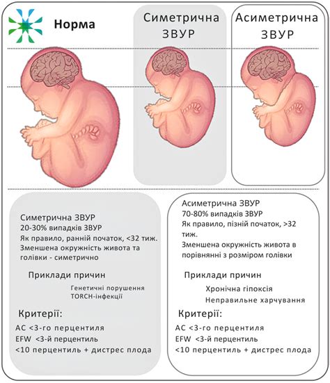 Затримка внутрішньоутробного розвитку плода ЗВУР
